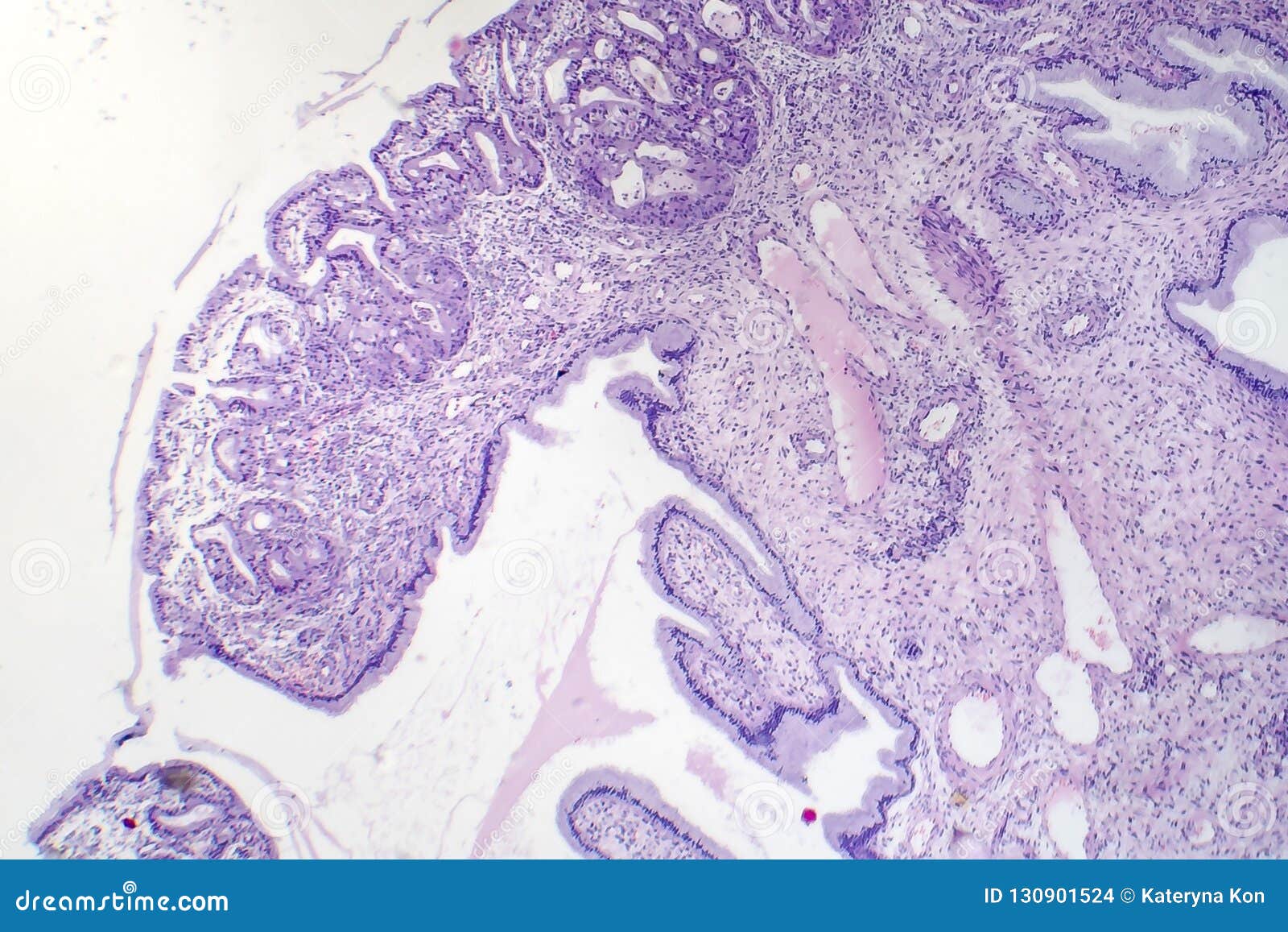Histopathology Of Nasal Polyps Royalty-Free Stock Photo | CartoonDealer ...
