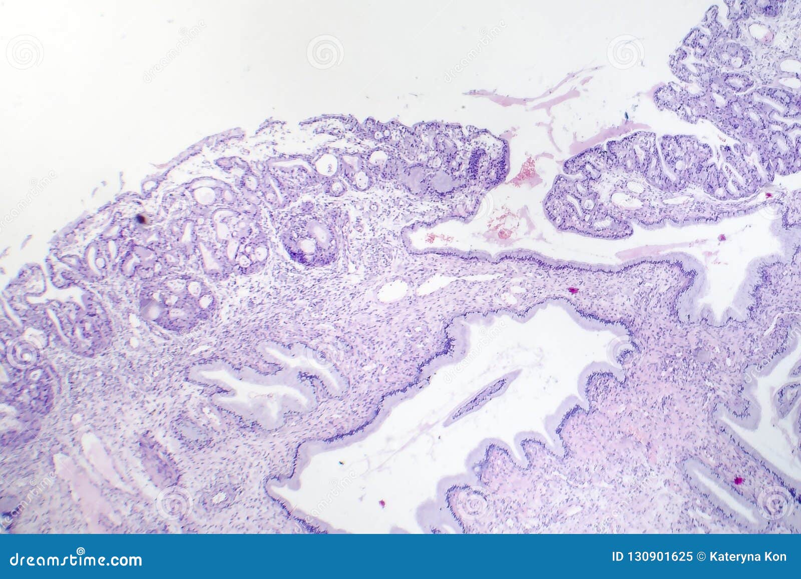Histopathology Of Nasal Polyps Royalty-Free Stock Photo | CartoonDealer ...