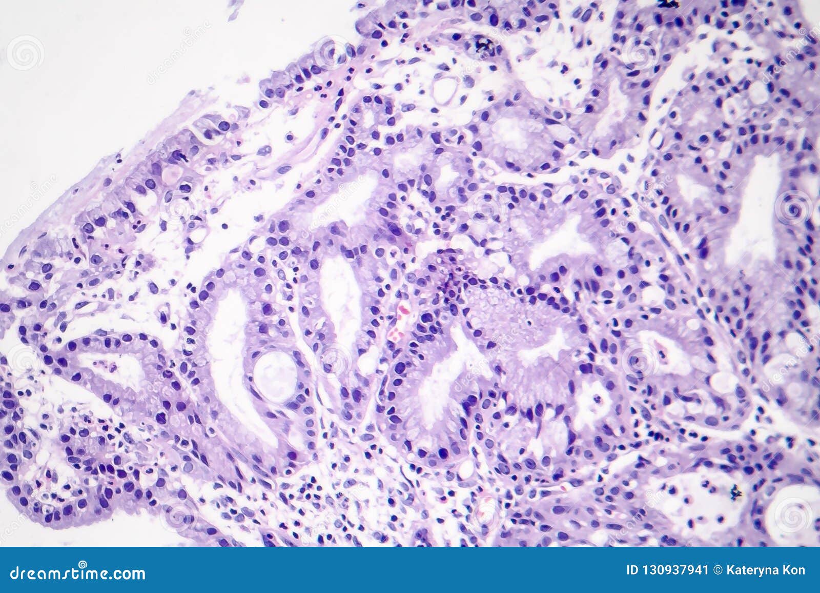 Histopathology of Nasal Polyps Stock Image - Image of medical, eosin ...