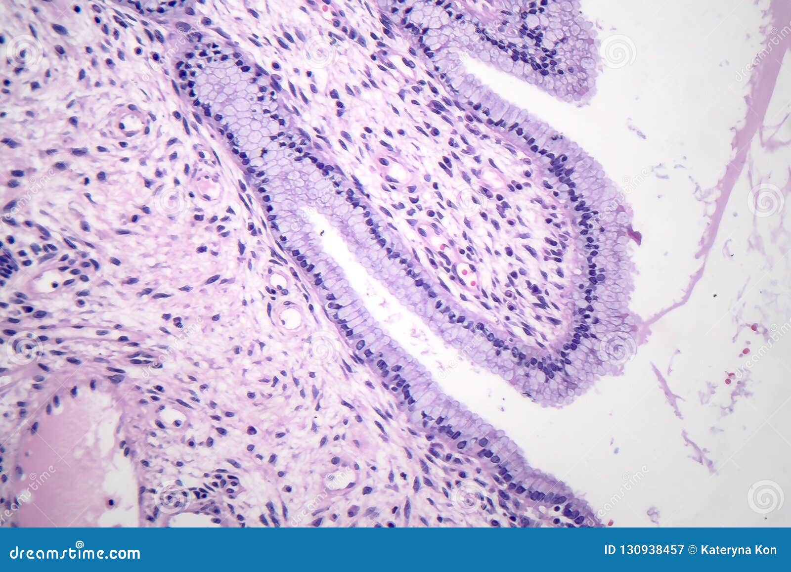 Histopathology of Nasal Polyps Stock Image - Image of cell, micro ...