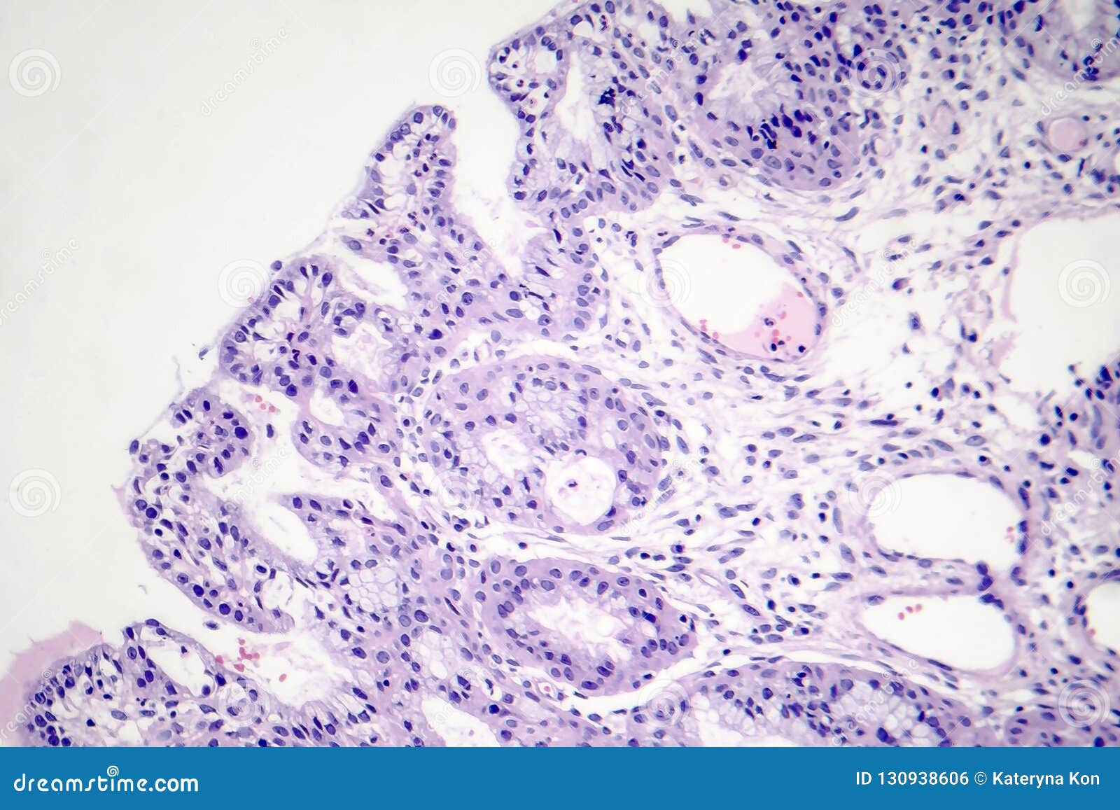 Histopathology of Nasal Polyps Stock Photo - Image of nose ...