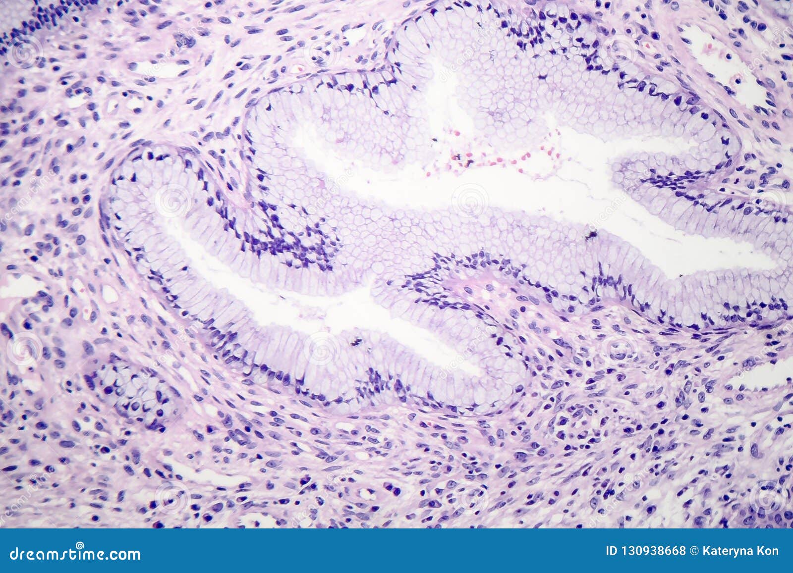 Histopathology of Nasal Polyps Stock Photo - Image of micrograph ...