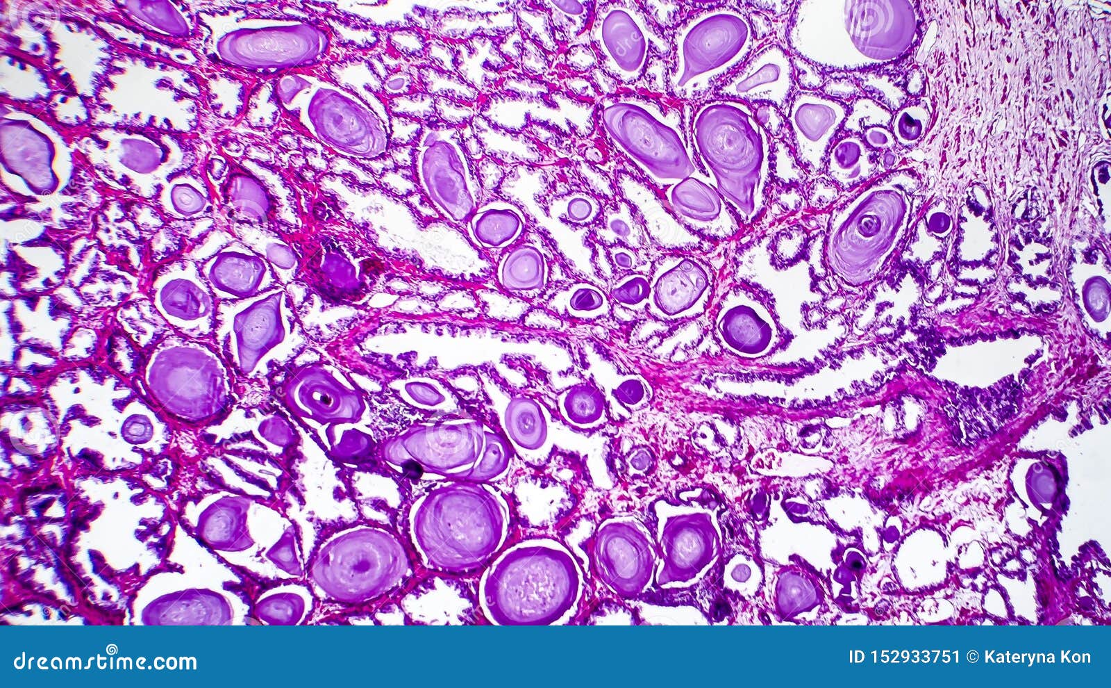 Histopathology of Prostate Gland Hyperplasia Stock Image - Image of ...