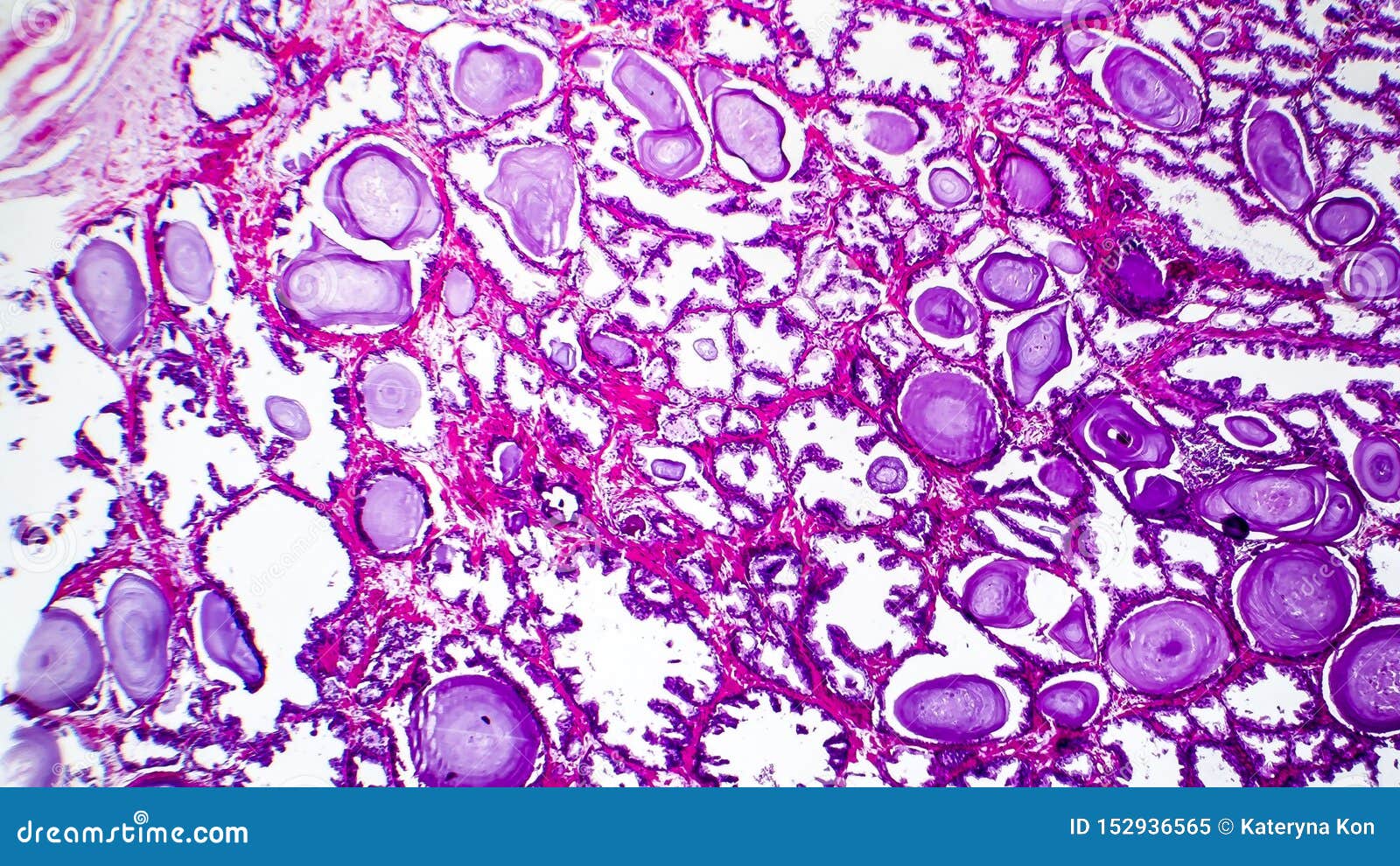Histopathology of Prostate Gland Hyperplasia Stock Image - Image of ...
