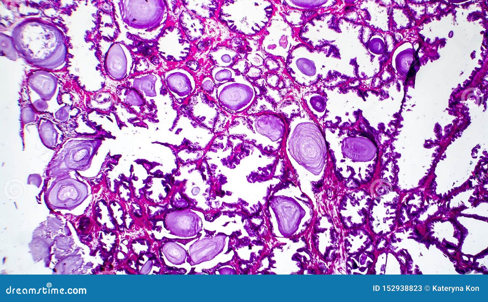 Histopathology Of Prostate Gland Hyperplasia Royalty-Free Stock ...