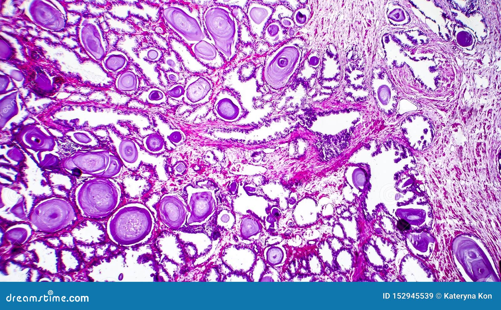 Histopathology of Prostate Gland Hyperplasia Stock Image - Image of ...