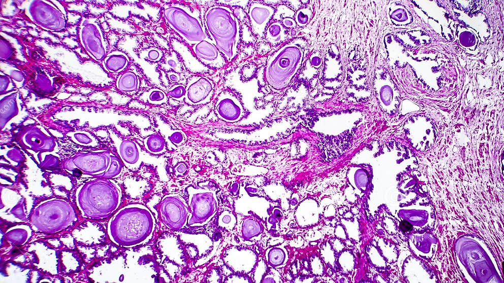 Histopathology of Prostate Gland Hyperplasia Stock Image - Image of ...