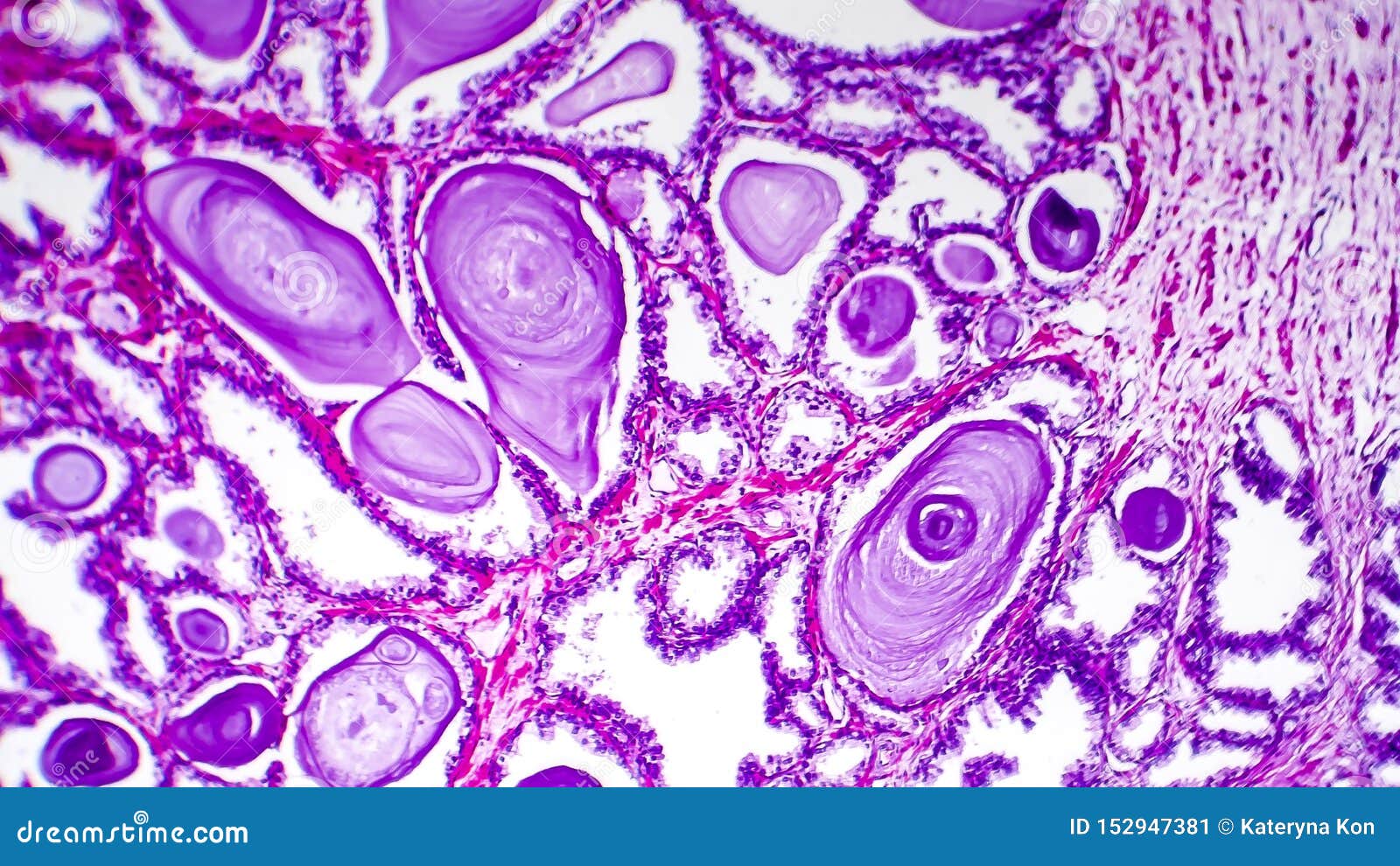 Histopathology Of Prostate Gland Hyperplasia Royalty-Free Stock Image ...