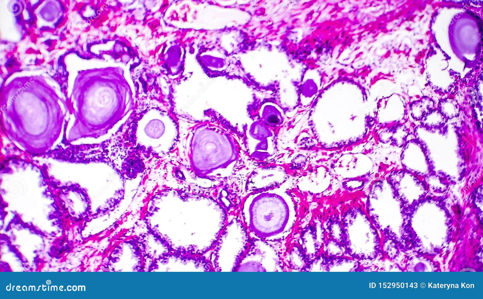 Histopathology of Prostate Gland Hyperplasia Stock Image - Image of ...