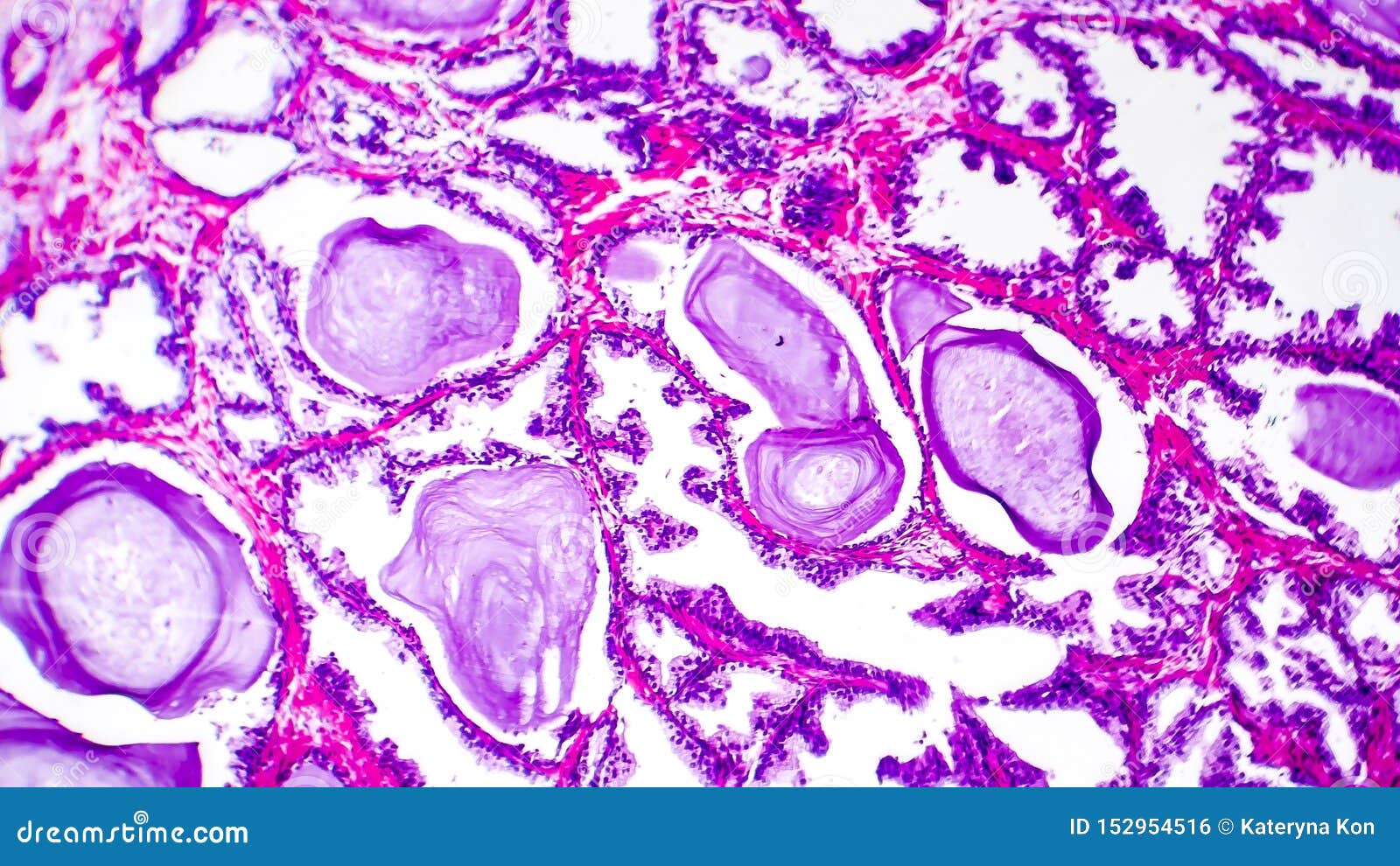 Histopathology of Prostate Gland Hyperplasia Stock Photo - Image of ...