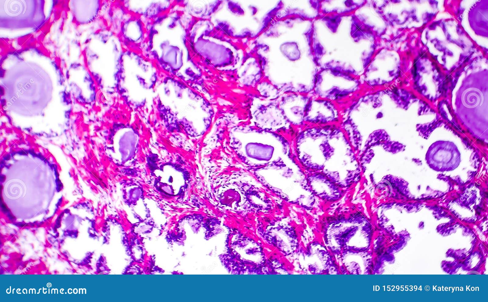 Histopathology of Prostate Gland Hyperplasia Stock Photo - Image of ...