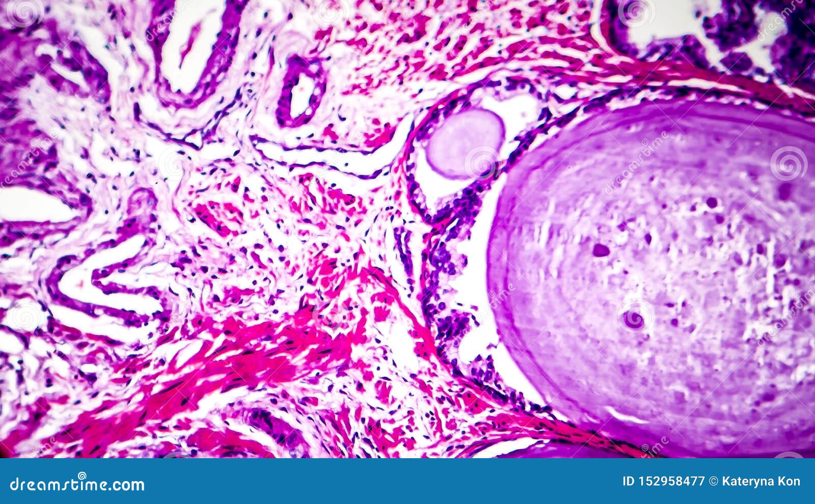 Histopathology of Prostate Gland Hyperplasia Stock Image - Image of ...