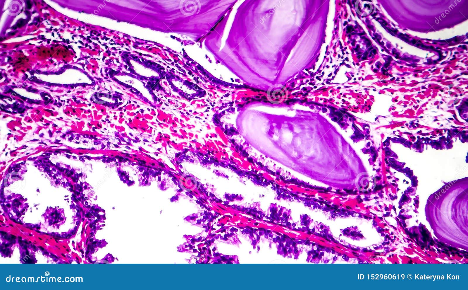 Histopathology of Prostate Gland Hyperplasia Stock Image - Image of ...