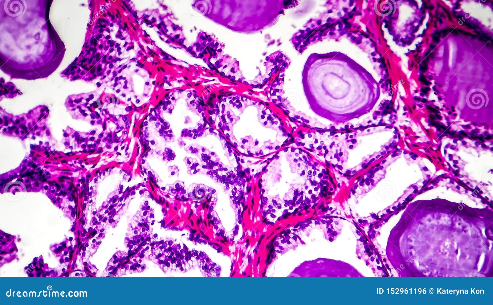 Histopathology of Prostate Gland Hyperplasia Stock Photo - Image of ...
