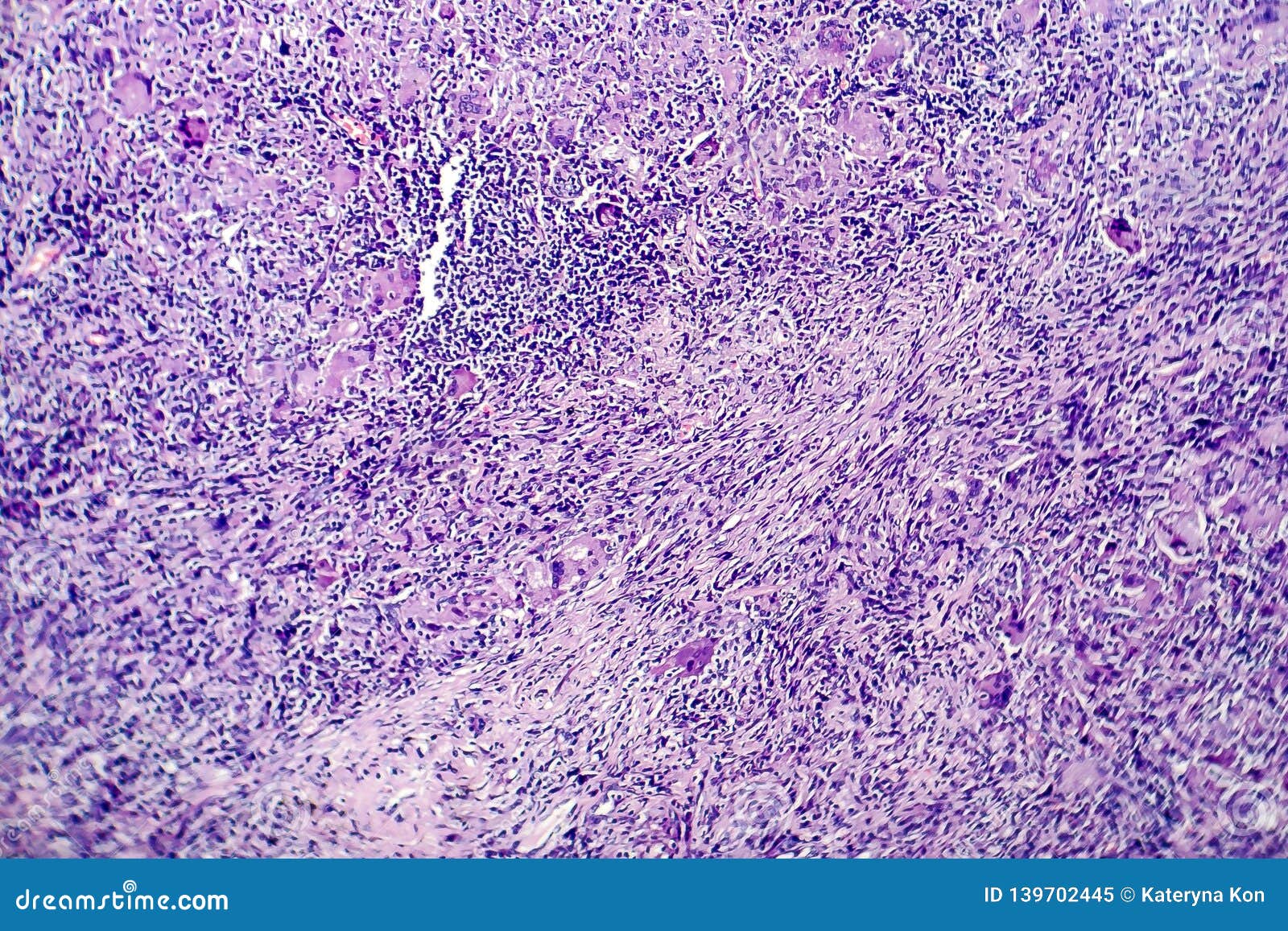 Histopathology of Tuberculosis Lesion Stock Image - Image of pulmonary ...