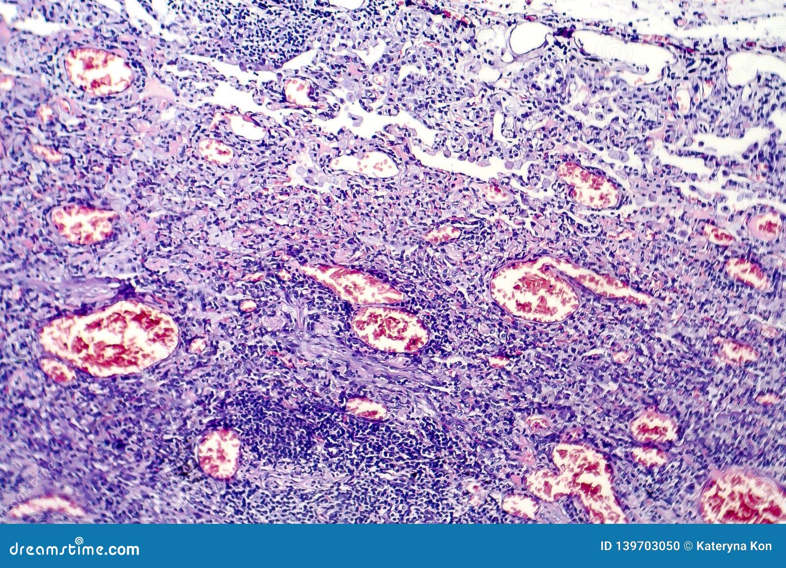 Histopathology of Tuberculosis Lesion Stock Photo - Image of ...