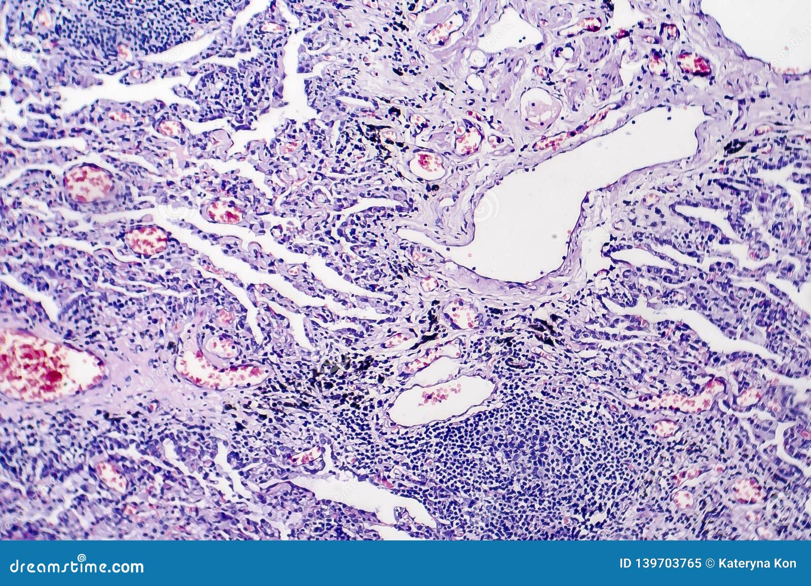 Histopathology of Tuberculosis Lesion Stock Image - Image of tubercle ...