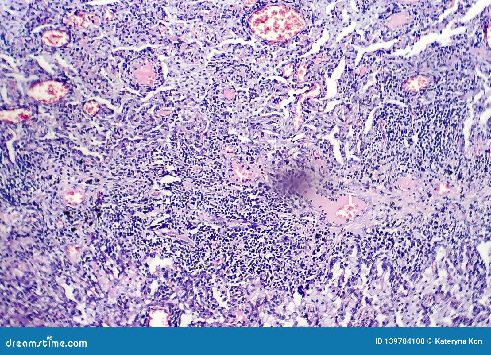 Histopathology of Tuberculosis Lesion Stock Photo - Image of micro ...