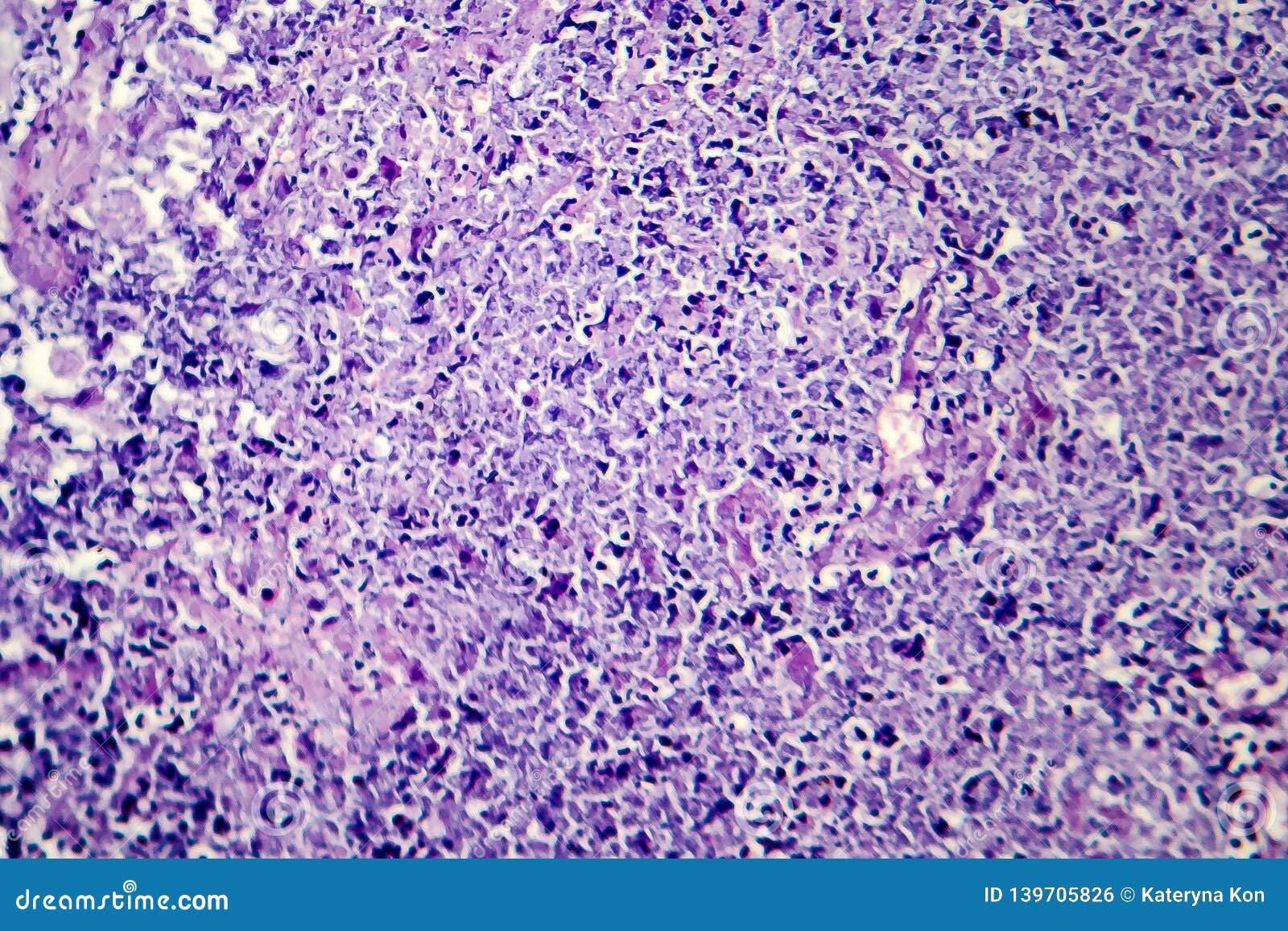 Histopathology of Tuberculosis Lesion Stock Photo - Image of microscopy ...