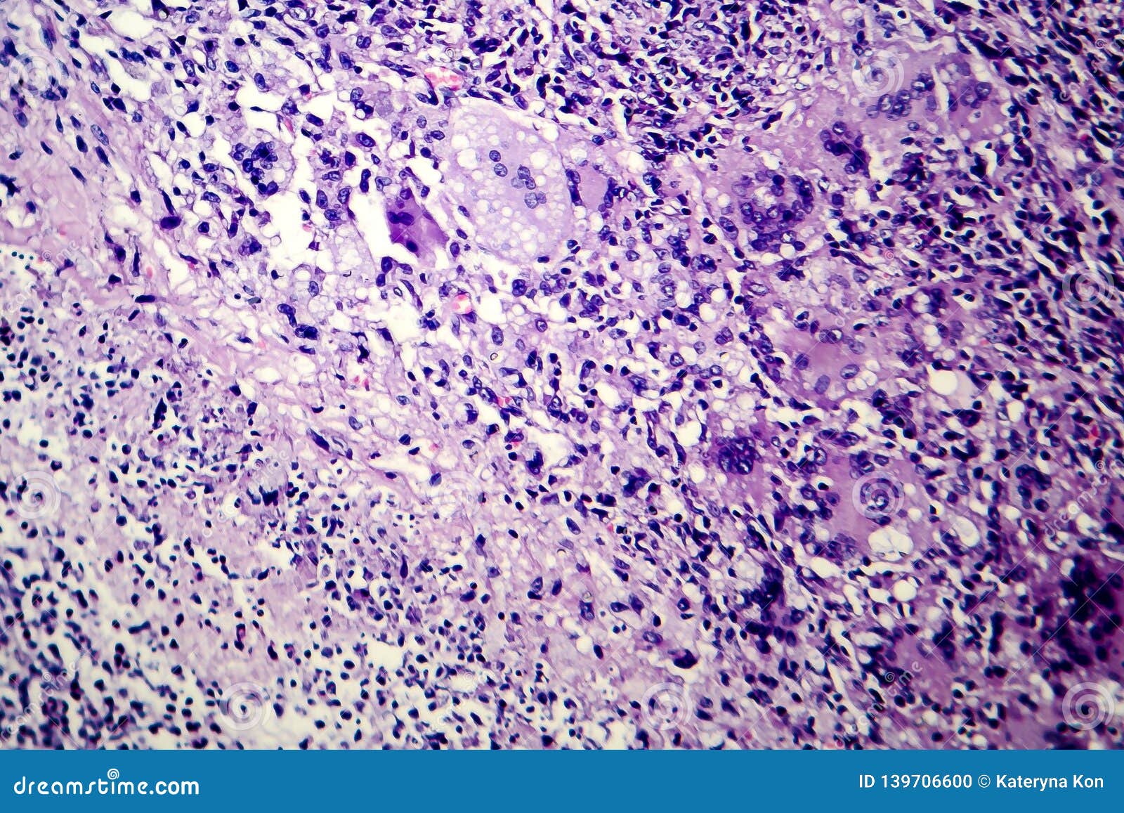 Histopathology of Tuberculosis Lesion Stock Photo - Image of pathogen ...