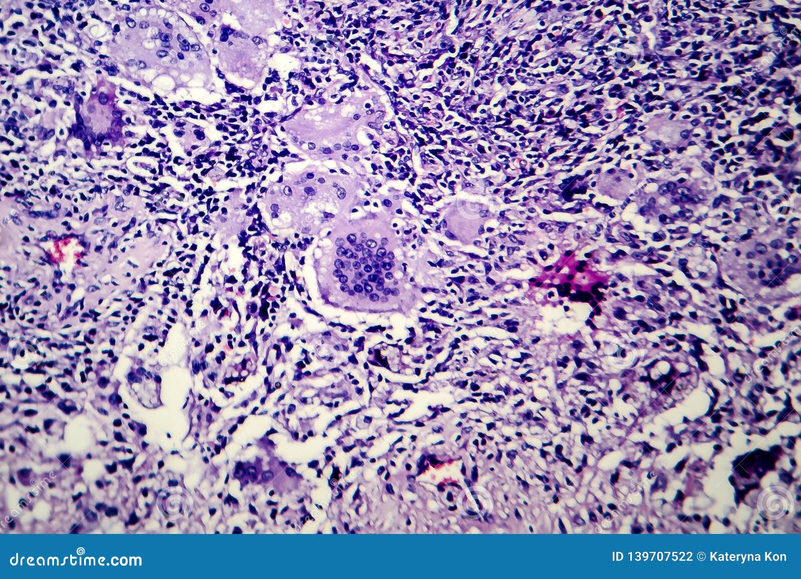 Histopathology of Tuberculosis Lesion Stock Photo - Image of micro ...