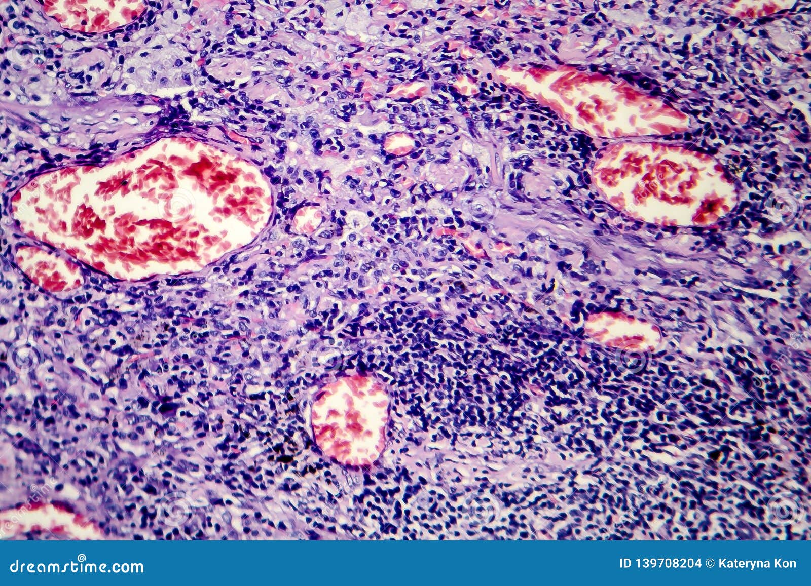 Histopathology of Tuberculosis Lesion Stock Photo - Image of ...