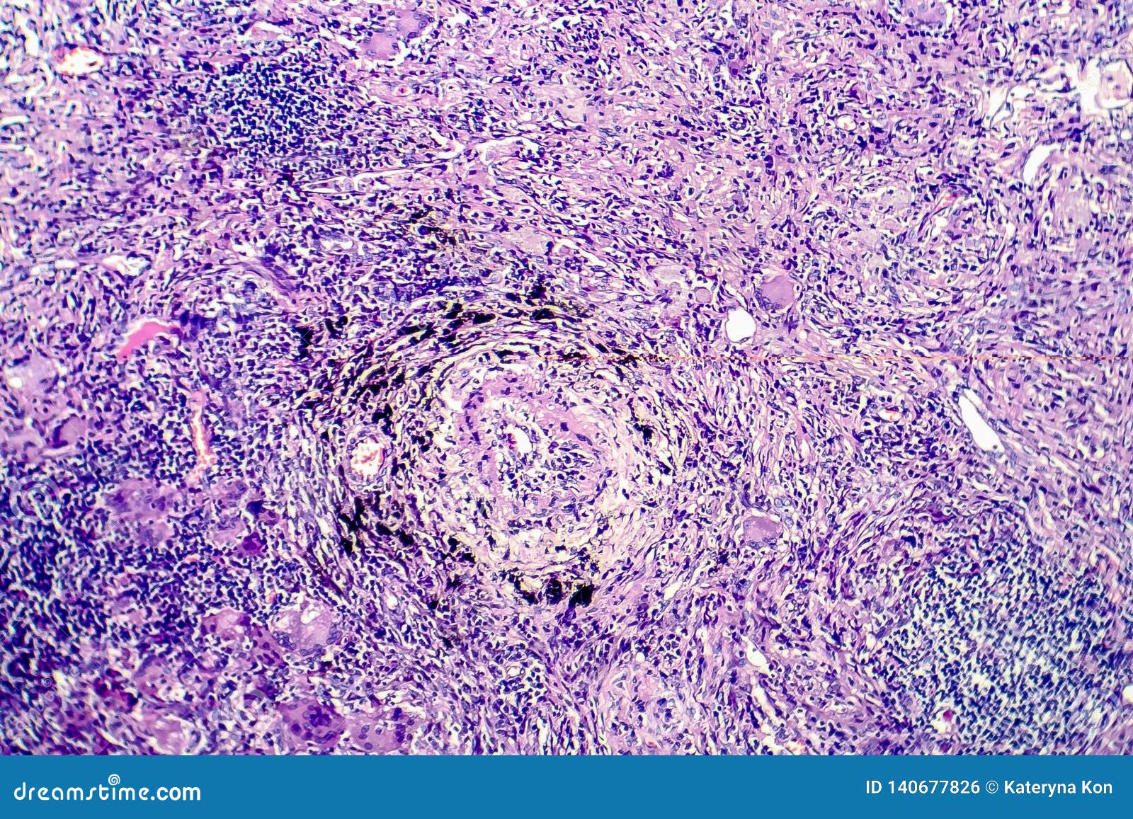 Histopathology of Tuberculosis Lesion Stock Photo - Image of microbe ...
