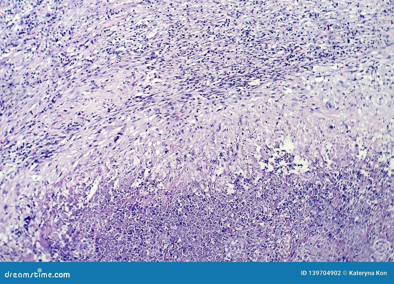 Histopathology of Tuberculosis Lesion Stock Photo - Image of ...