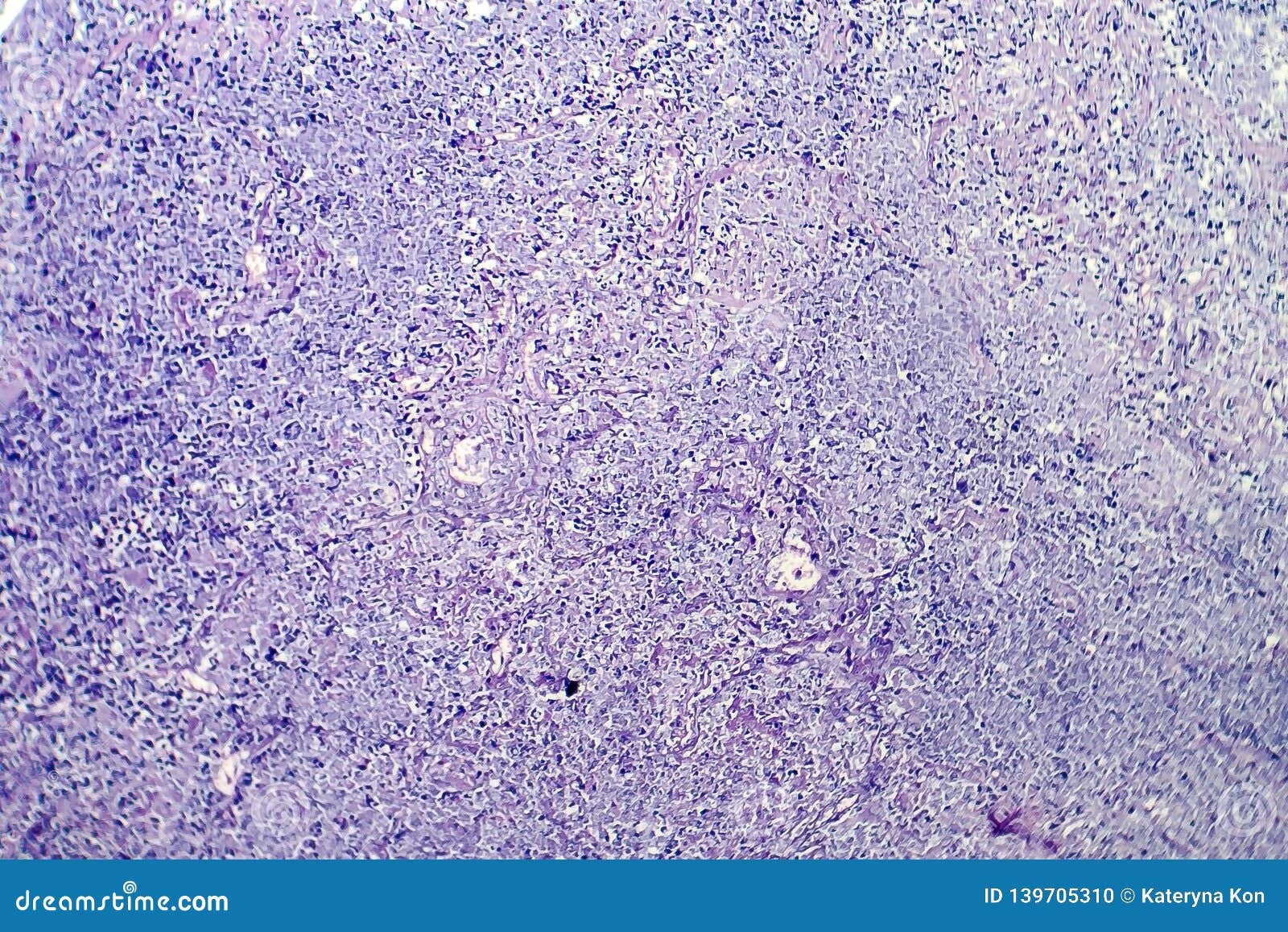 Histopathology of Tuberculosis Lesion Stock Photo - Image of ...