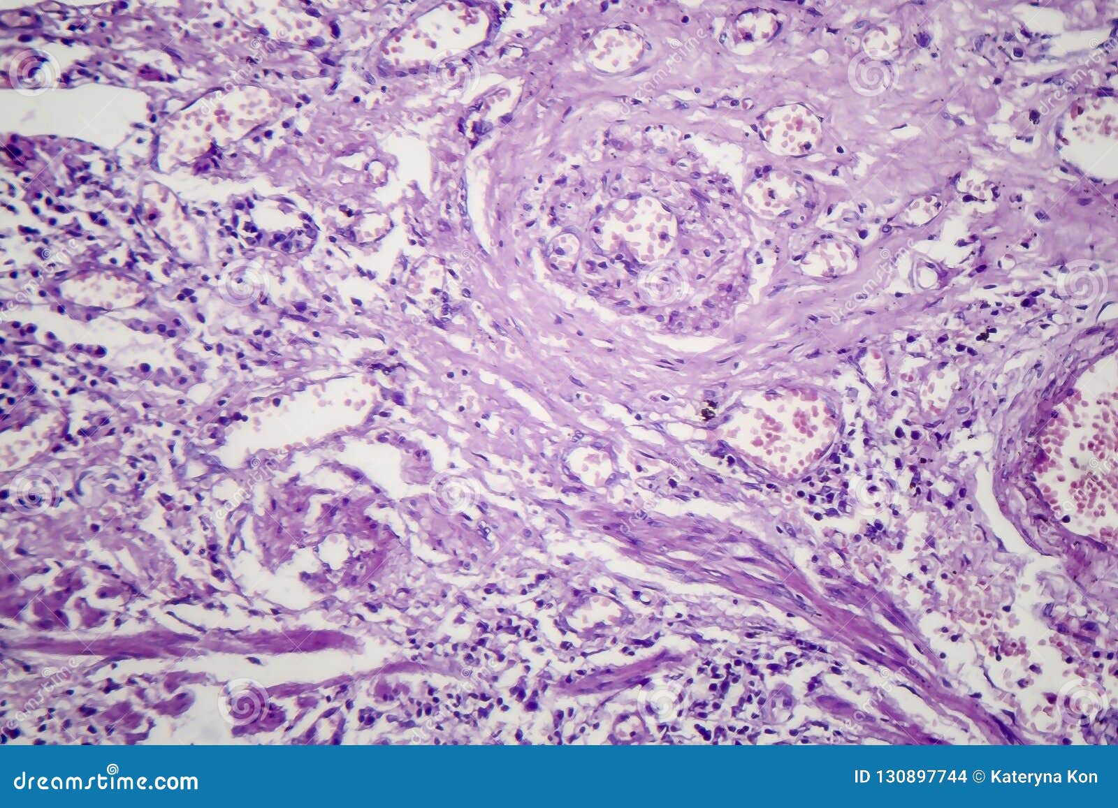 Histopathology of Viral Pneumonia Stock Photo - Image of eosin ...