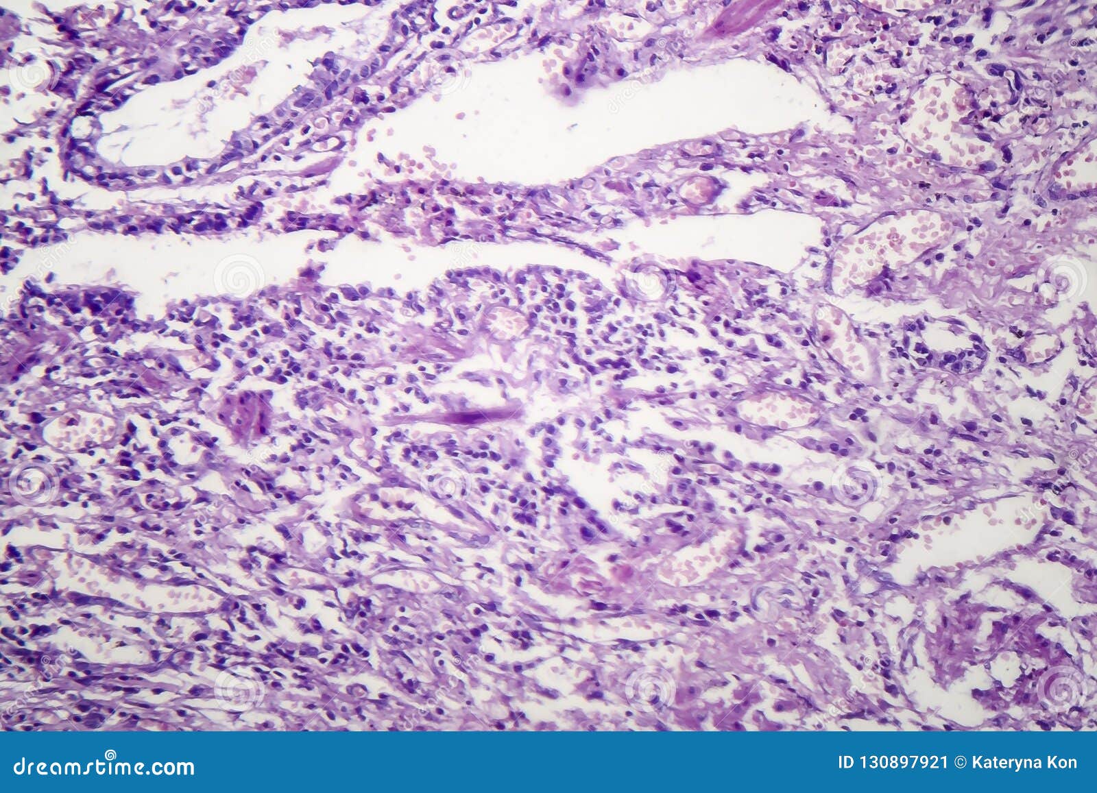 Histopathology of Viral Pneumonia Stock Image - Image of magnification ...