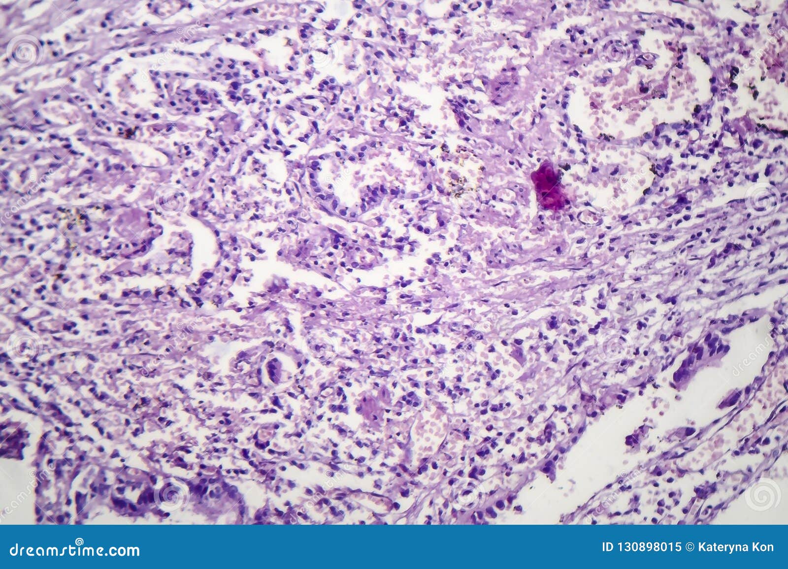 Histopathology of Viral Pneumonia Stock Image - Image of lung, micro ...