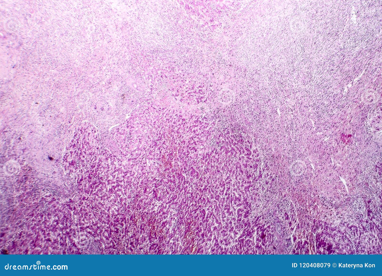 Histopatología Del Absceso Del Hígado Imagen de archivo - Imagen de ...