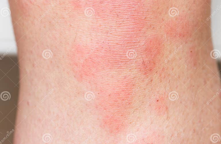 Hives On Skin Urticaria Rash Skin Allergies Uk Stock Image Image