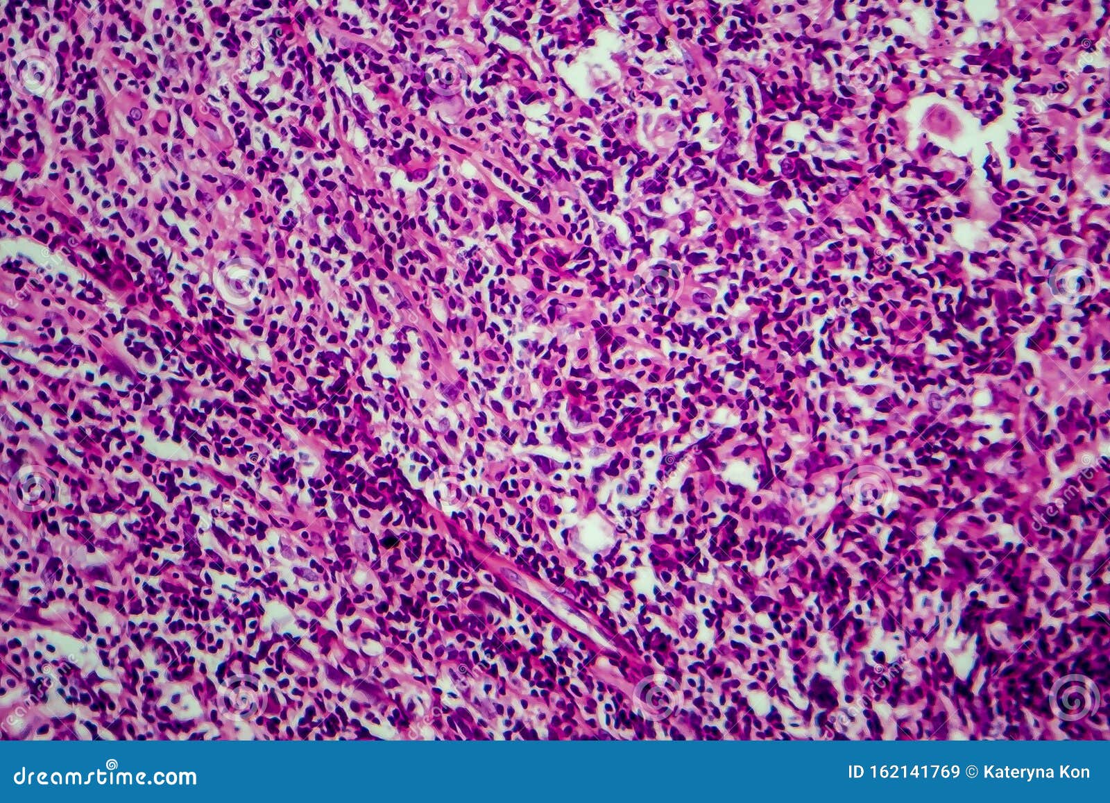 Hodgkin`s Lymphoma, Light Micrograph Stock Image - Image of ...