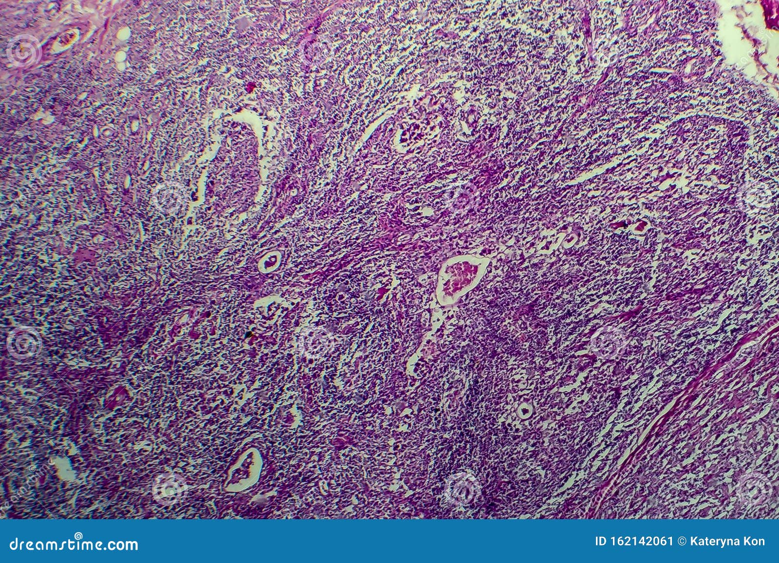 Hodgkin`s Lymphoma, Light Micrograph Stock Image - Image of hematoxylin ...