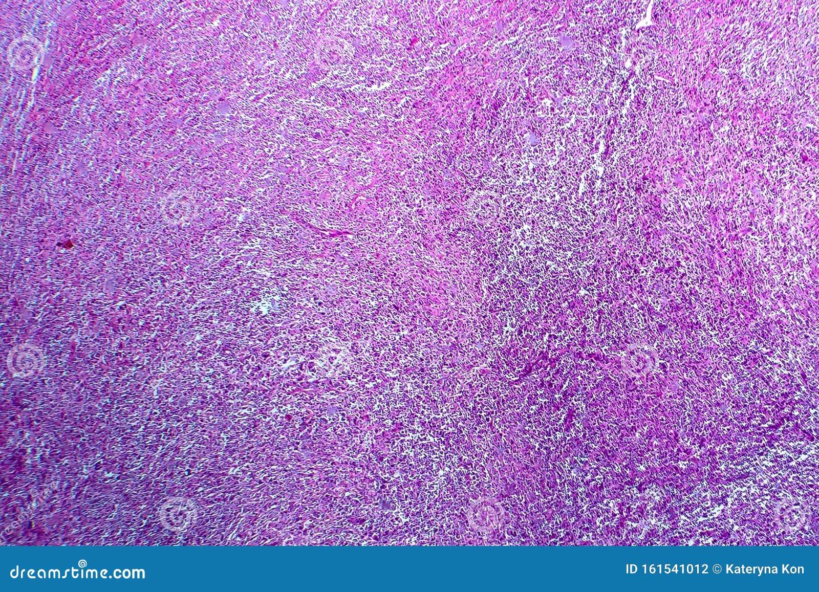 Hodgkin`s Lymphoma, Light Micrograph Stock Photo - Image of oncology ...