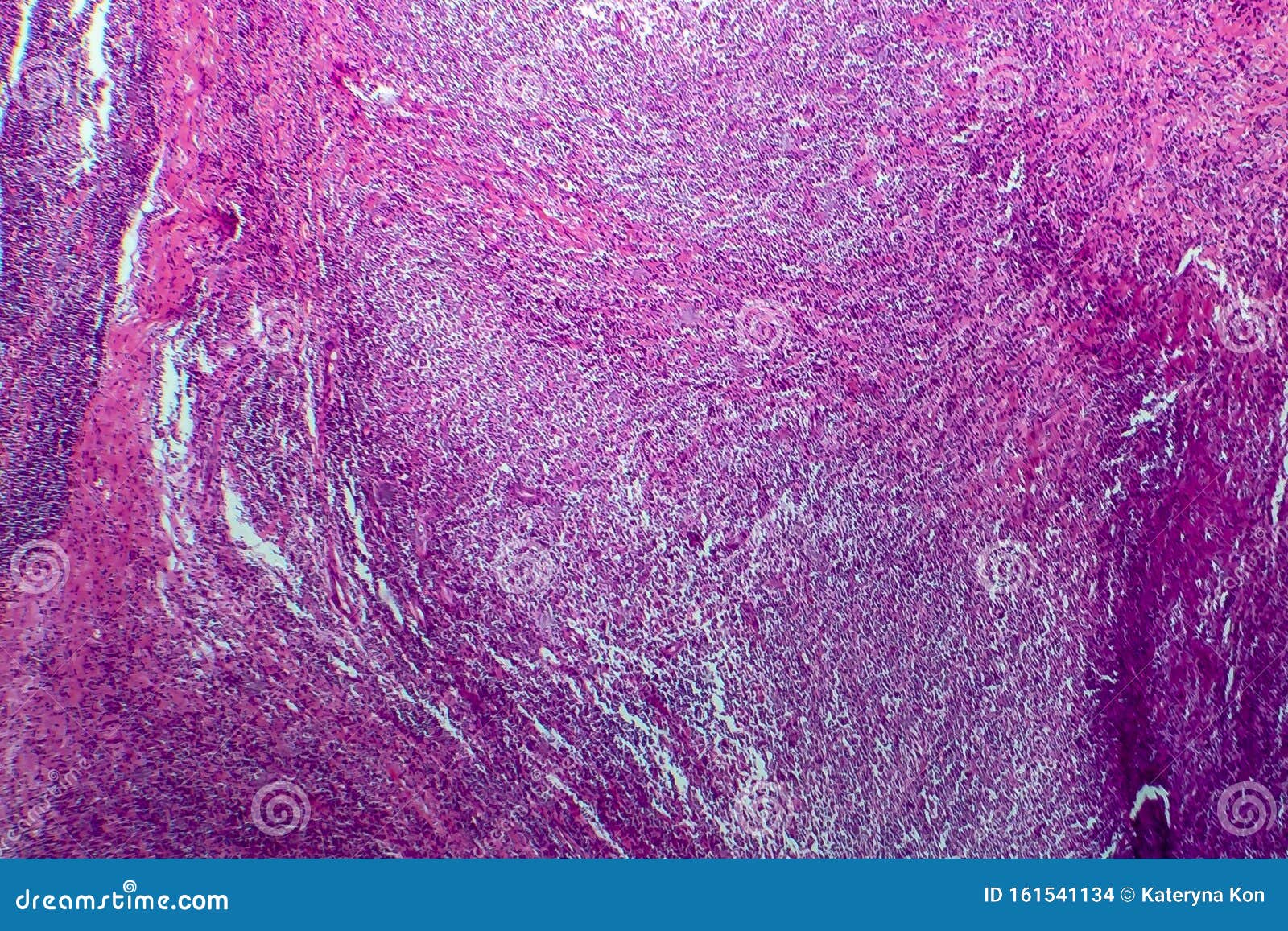 Hodgkin`s Lymphoma, Light Micrograph Stock Photo - Image of lymphoma ...
