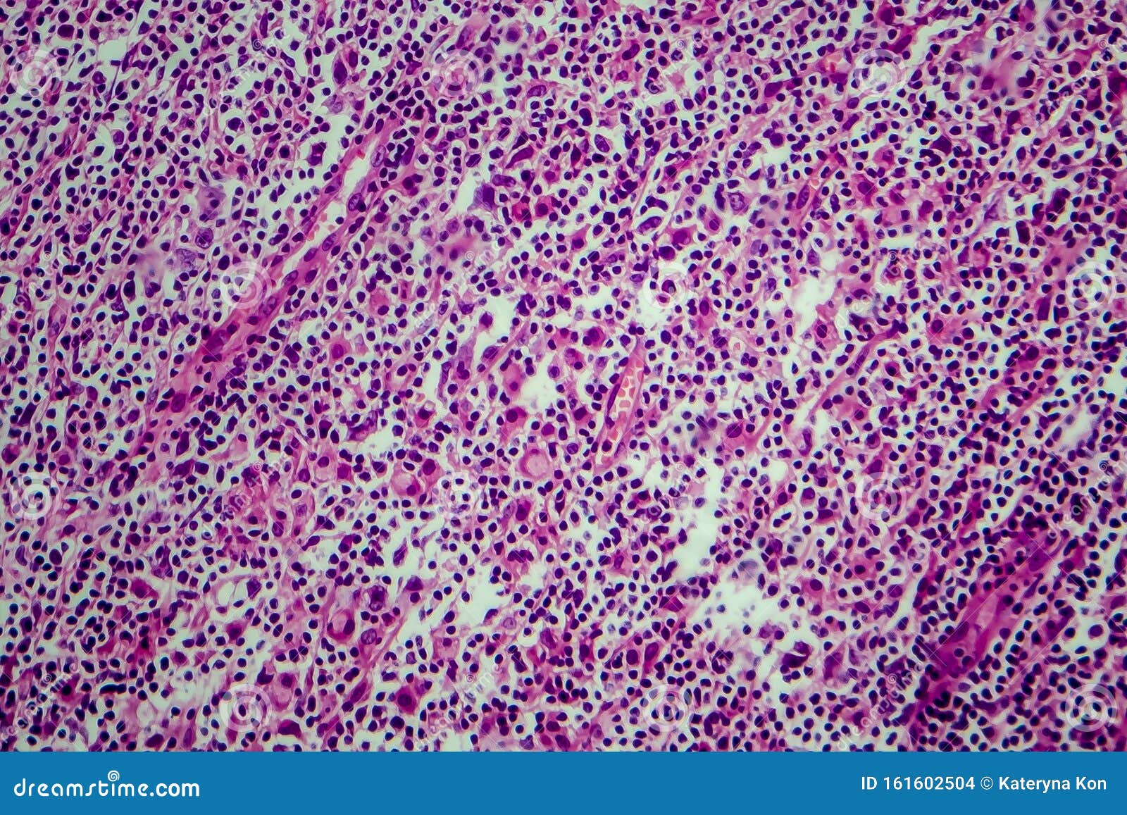 Hodgkin`s Lymphoma, Light Micrograph Stock Photo - Image of hematoxylin ...