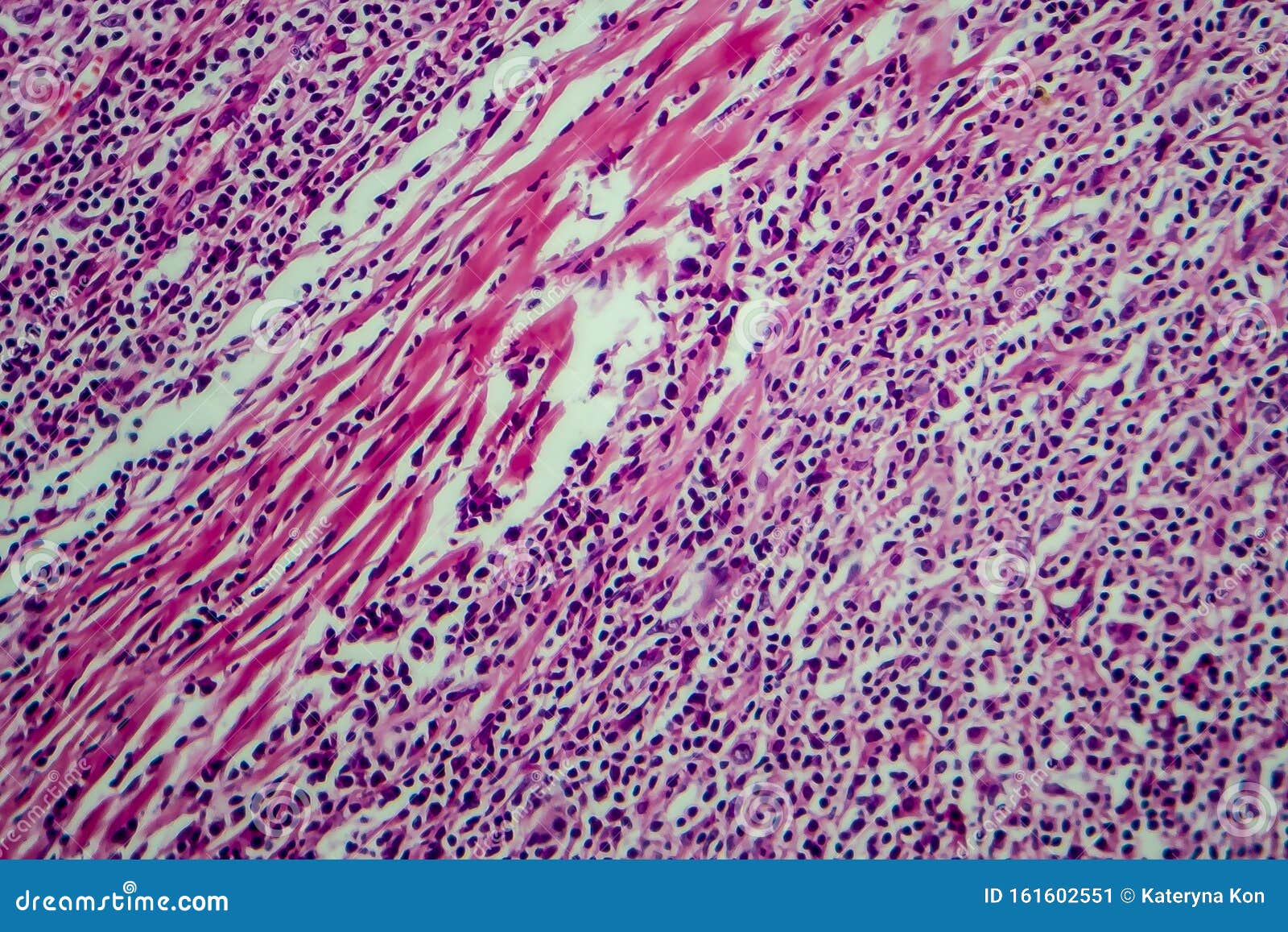 Hodgkin`s Lymphoma, Light Micrograph Stock Image - Image of micrograph ...