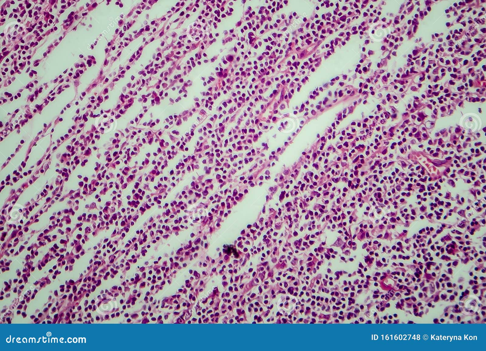 Hodgkin`s Lymphoma, Light Micrograph Stock Photo - Image of hematoxylin ...