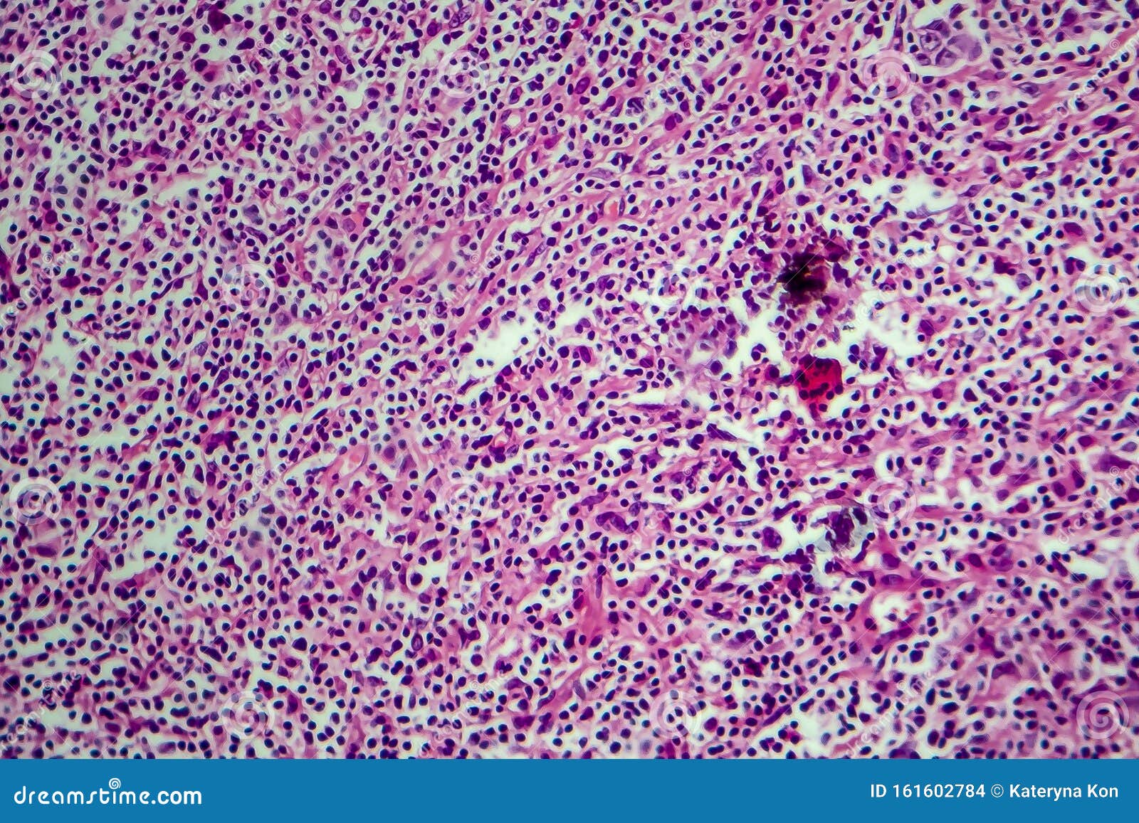 Hodgkin`s Lymphoma, Light Micrograph Stock Photo - Image of stain ...