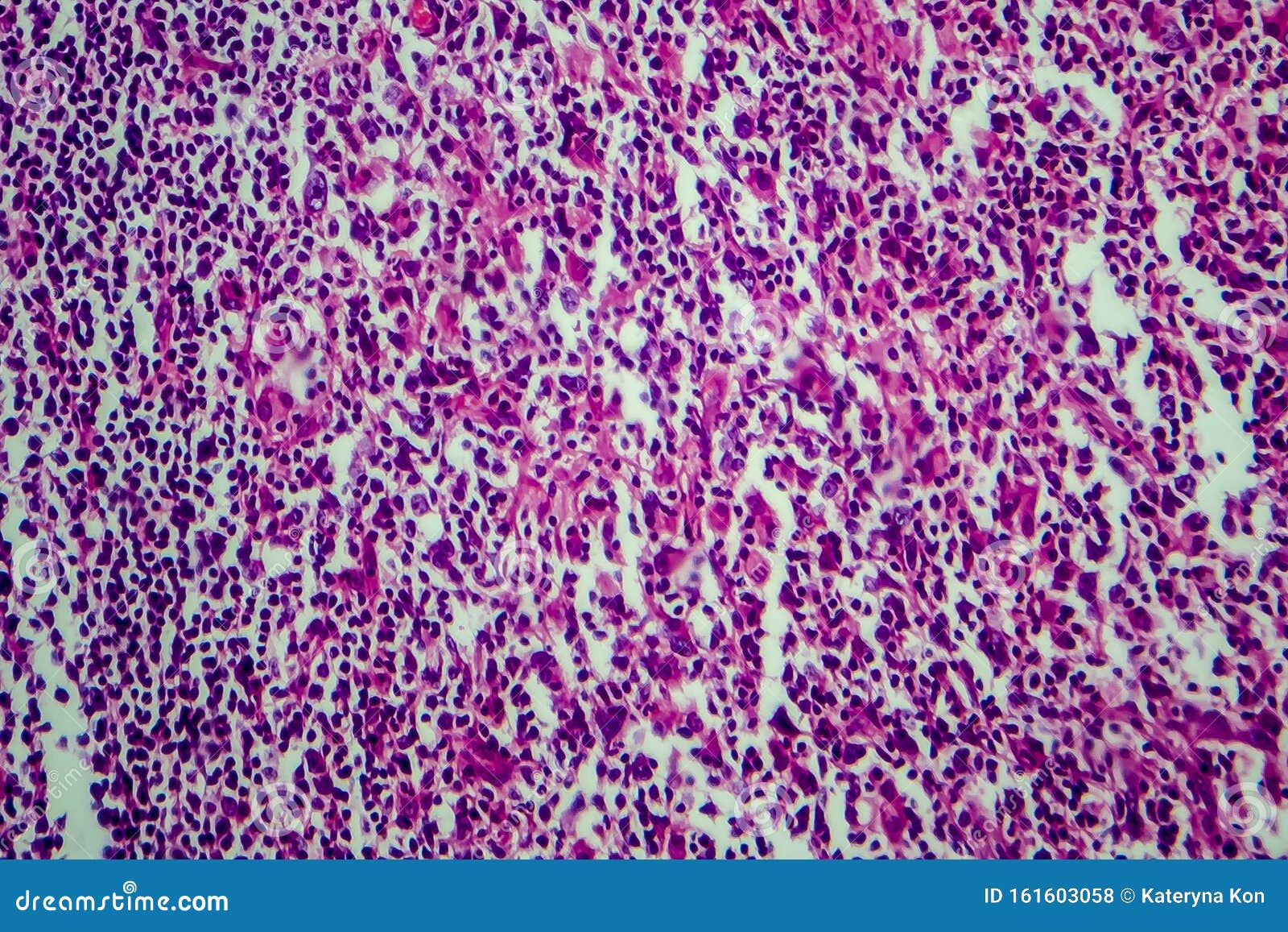 Hodgkin`s Lymphoma, Light Micrograph Stock Photo - Image of cancer ...