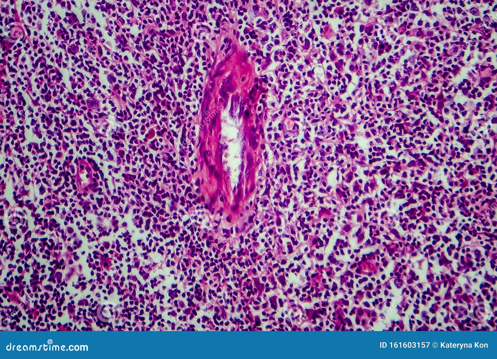 Hodgkin`s Lymphoma, Light Micrograph Stock Image - Image of histology ...
