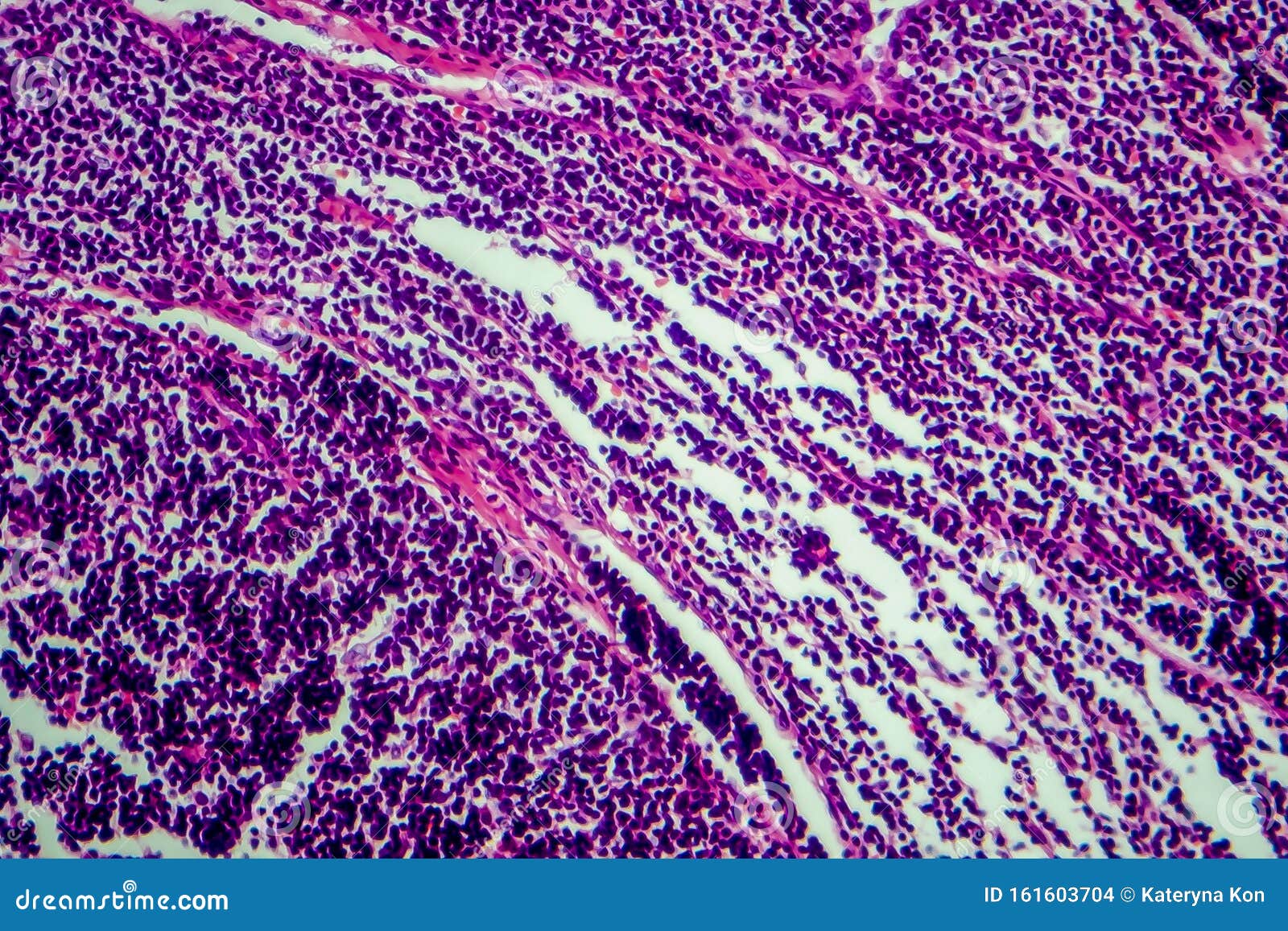 Hodgkin`s Lymphoma, Light Micrograph Stock Photo - Image of hematoxylin ...