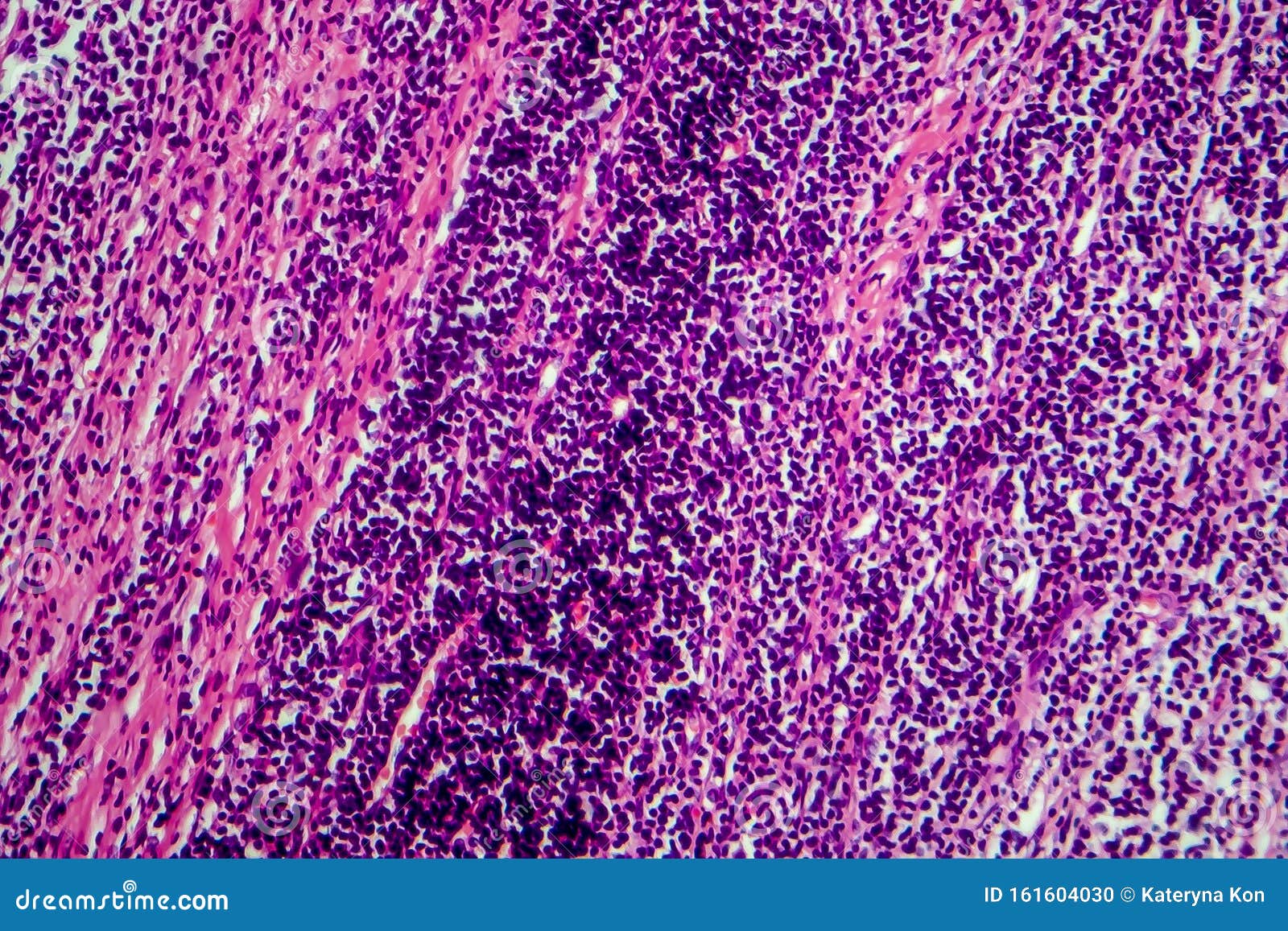 Hodgkin`s Lymphoma, Light Micrograph Stock Photo - Image of ...
