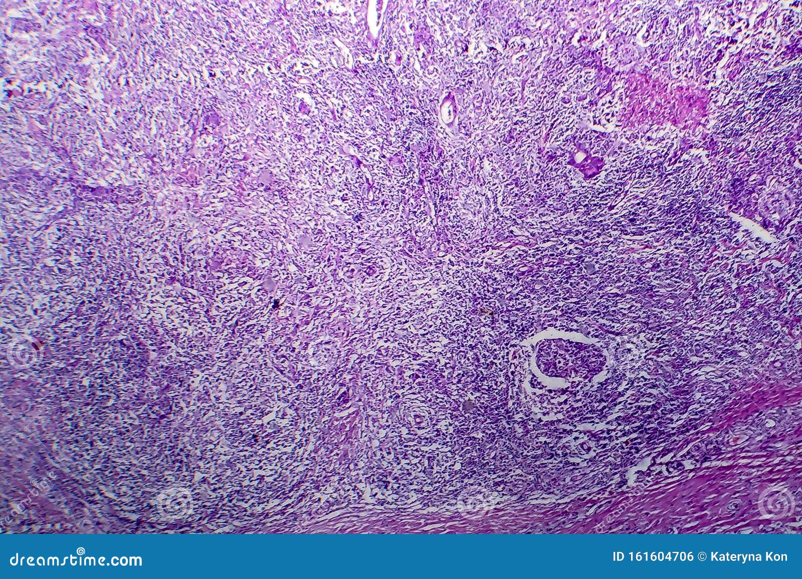 Hodgkin`s Lymphoma, Light Micrograph Stock Photo - Image of cell ...
