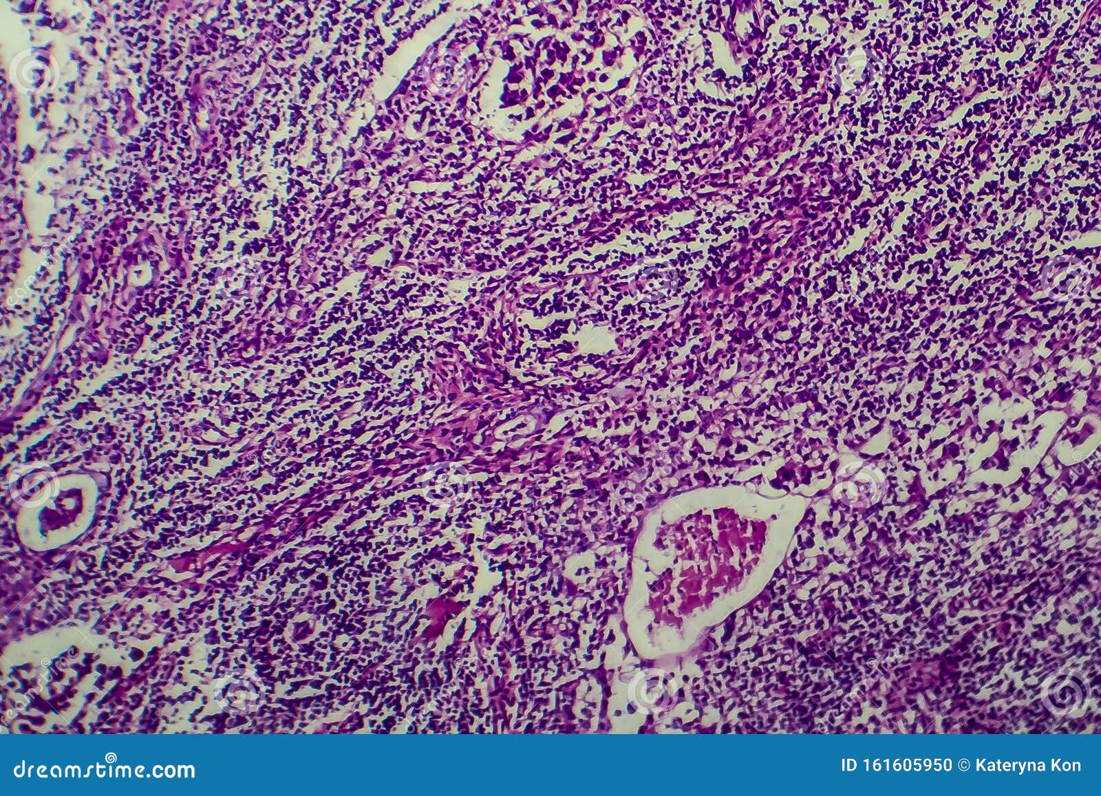Hodgkin`s Lymphoma, Light Micrograph Stock Photo - Image of tumor ...