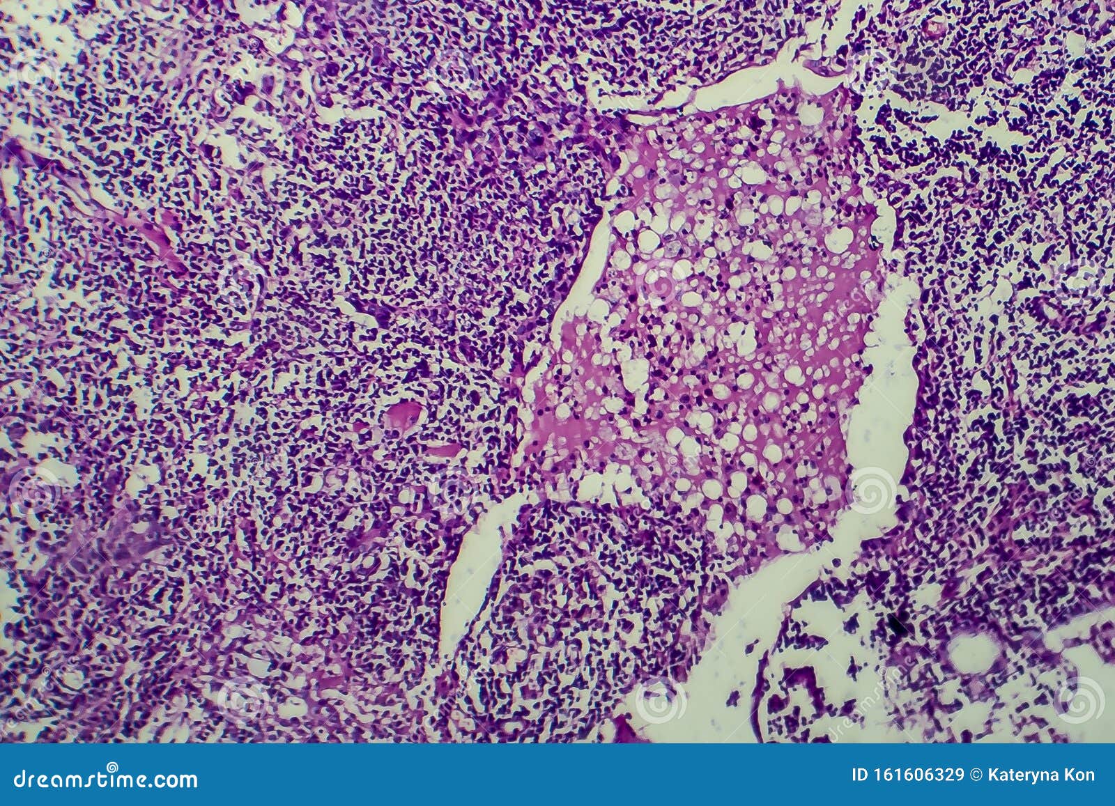 Hodgkin`s Lymphoma, Light Micrograph Stock Image - Image of cell ...