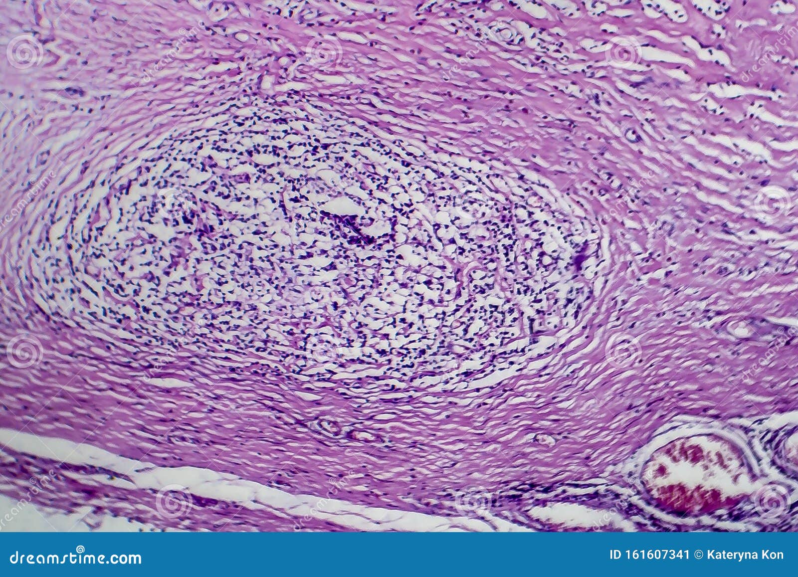 Hodgkin`s Lymphoma, Light Micrograph Stock Image - Image of pathology ...